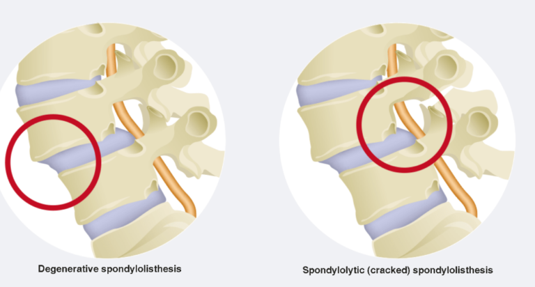 What is Spondylolisthesis? | International Lumbago Clinic