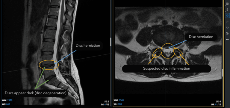 Free MRI Consultation - Case No. 1 | International Lumbago Clinic Tokyo ...