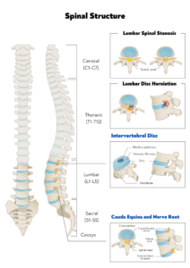 What is spinal canal stenosis? A back pain professional explains ...