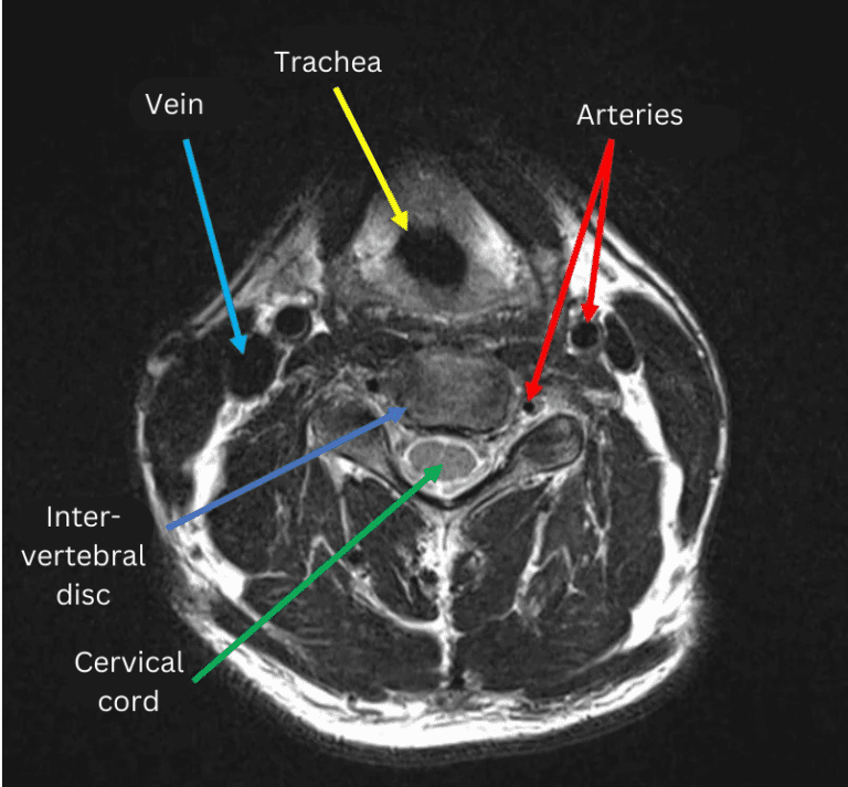 The proper Way to Look at a MRI Scan of The Cervical Spine ...