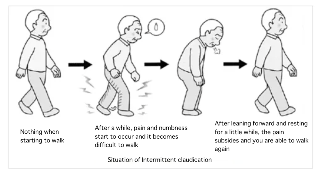 Is it Spondylolisthesis? How to Check if You Have The Symptoms ...