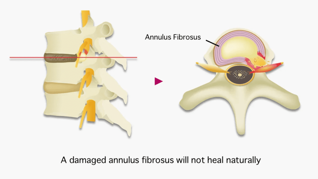What is a “Strained Back”? What is the Reason Behind it? What is the ...