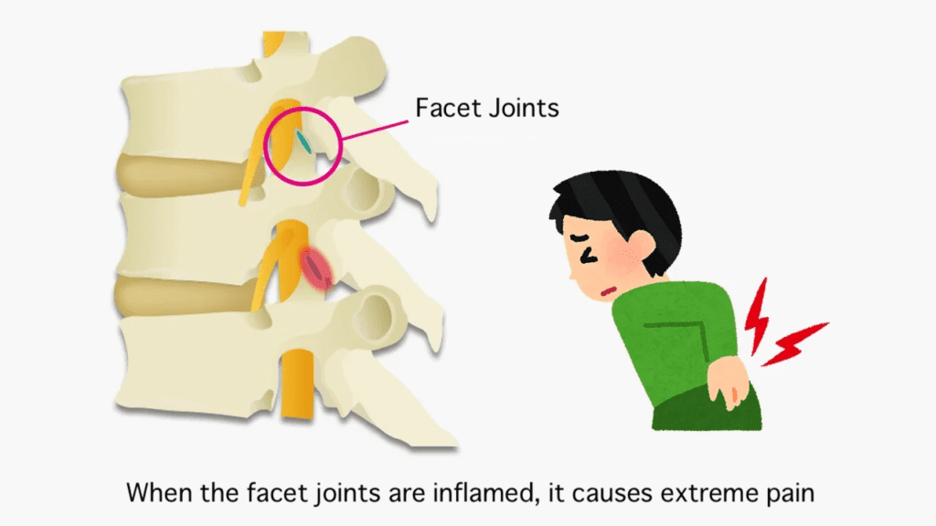What is a “Strained Back”? What is the Reason Behind it? What is the ...