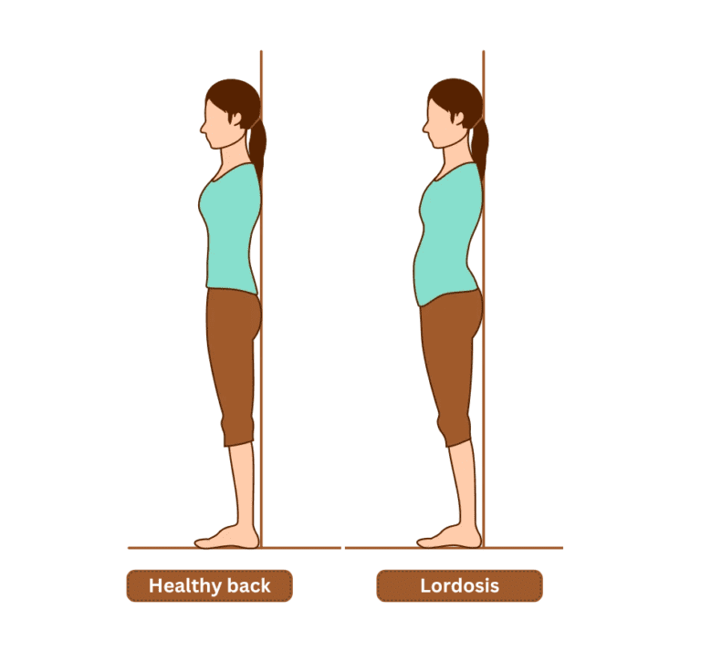 What is Lordosis? Its Various Causes and How to Identify and Remedy ...
