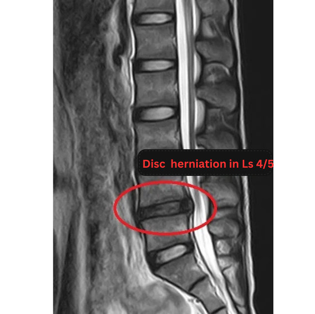 Treatment Case Report No. 6｜ ILC International Low Back Pain Clinic ...