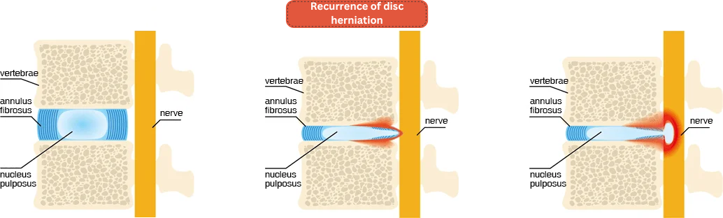 Recurrence and Reoperation of Lumbar Disc Herniation: Proper ...