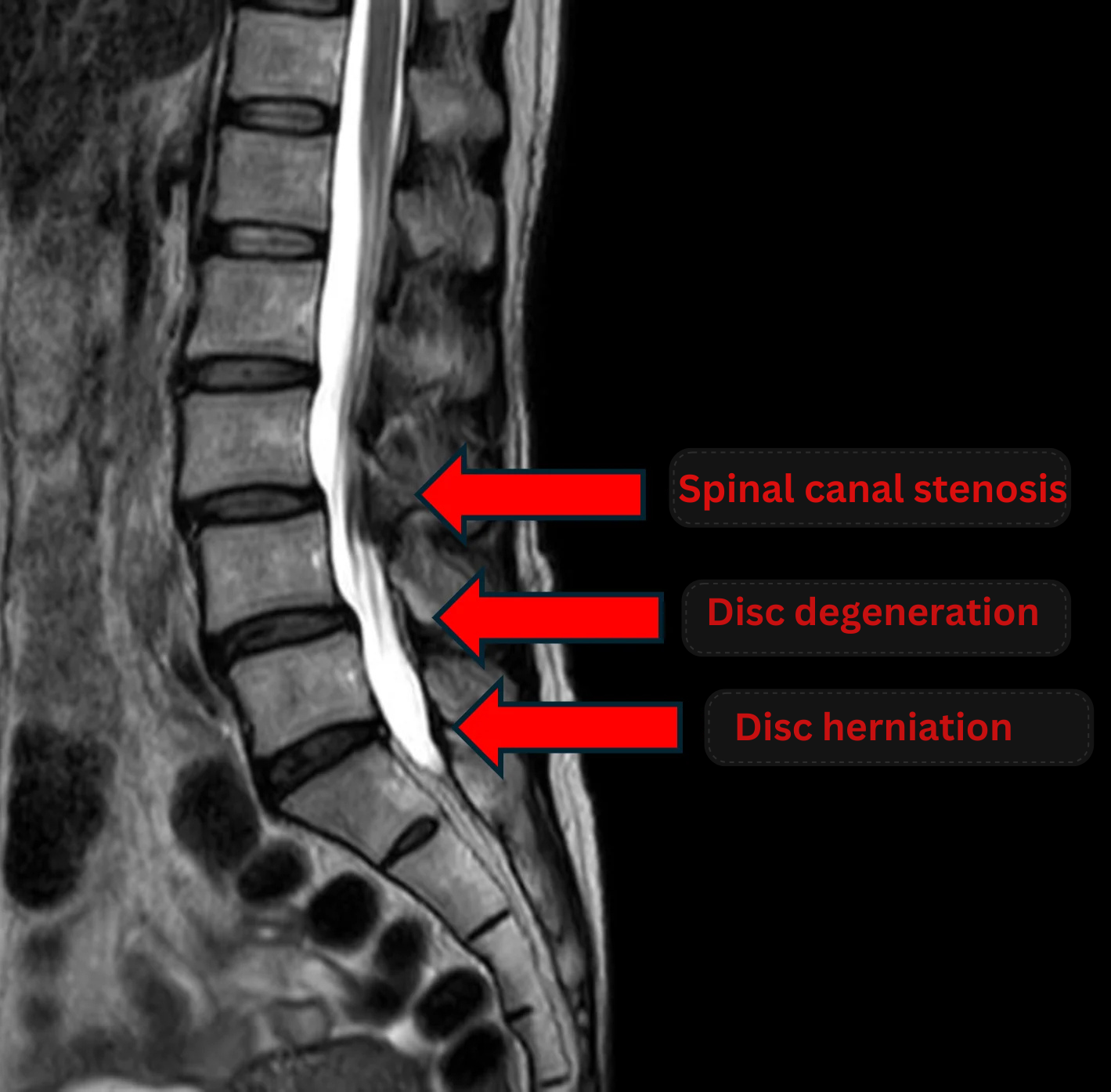 Balancing Work and Disc Herniation: Key Points for Adjusting Your Work ...