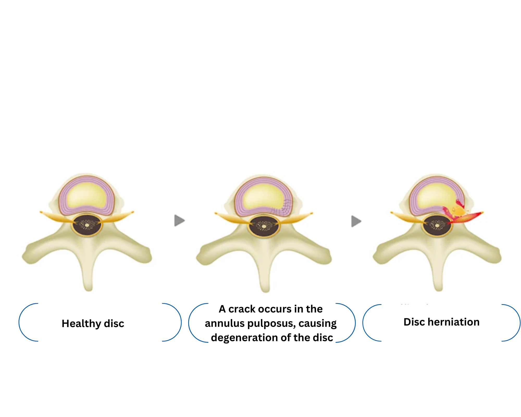Can Disc Herniation Heal Naturally? | International Lumbago Clinic